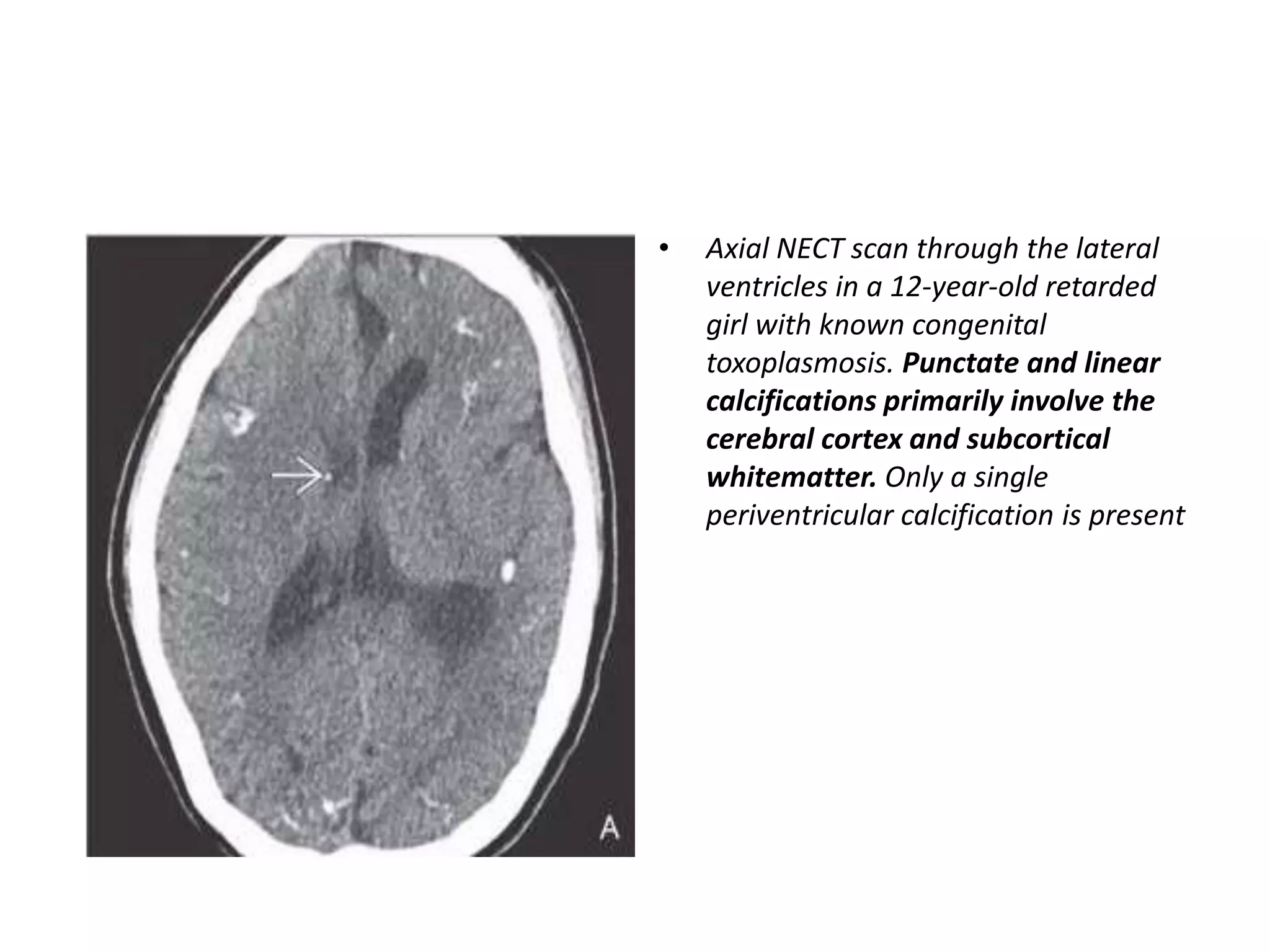 Intracranial infections | PPT