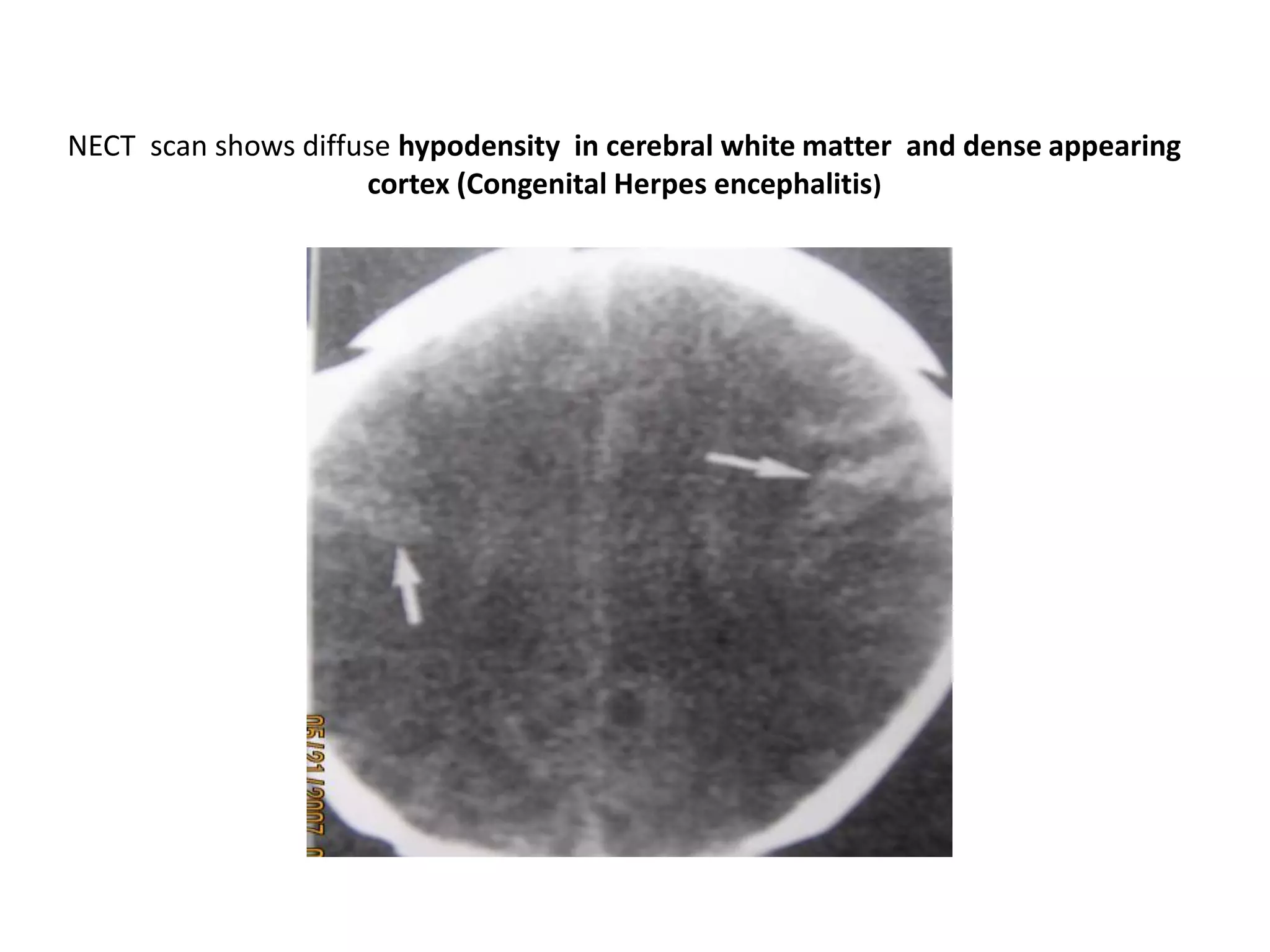Intracranial infections | PPT