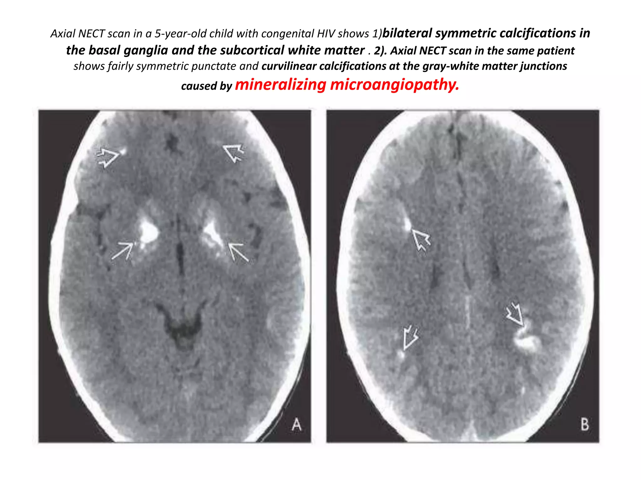 Intracranial infections | PPT