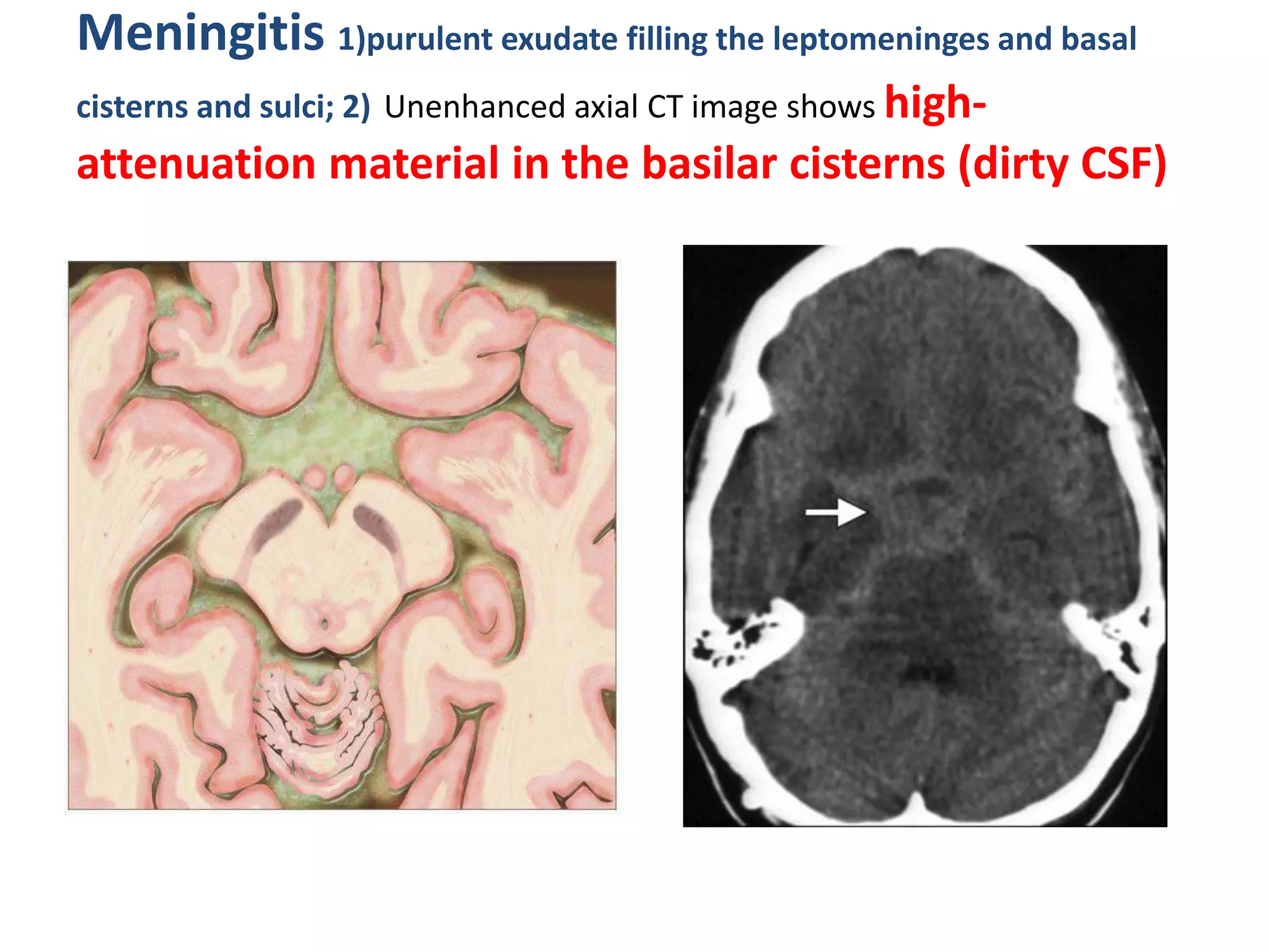 Intracranial infections | PPT