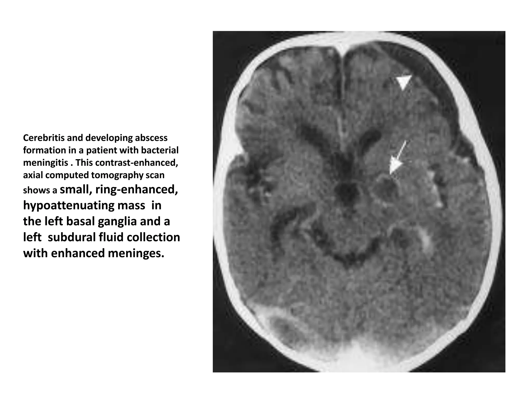 Intracranial infections | PPT