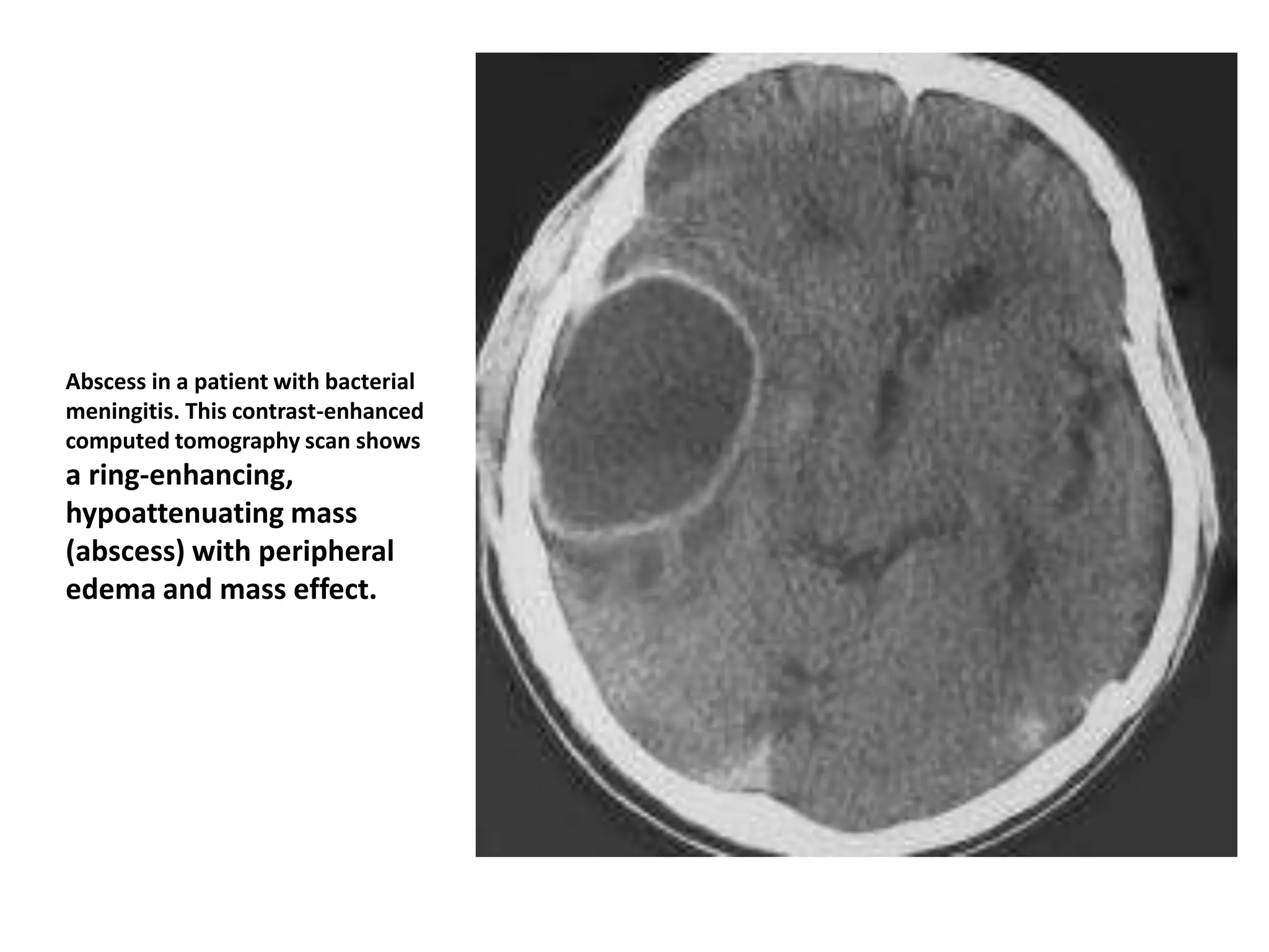 Intracranial infections | PPT