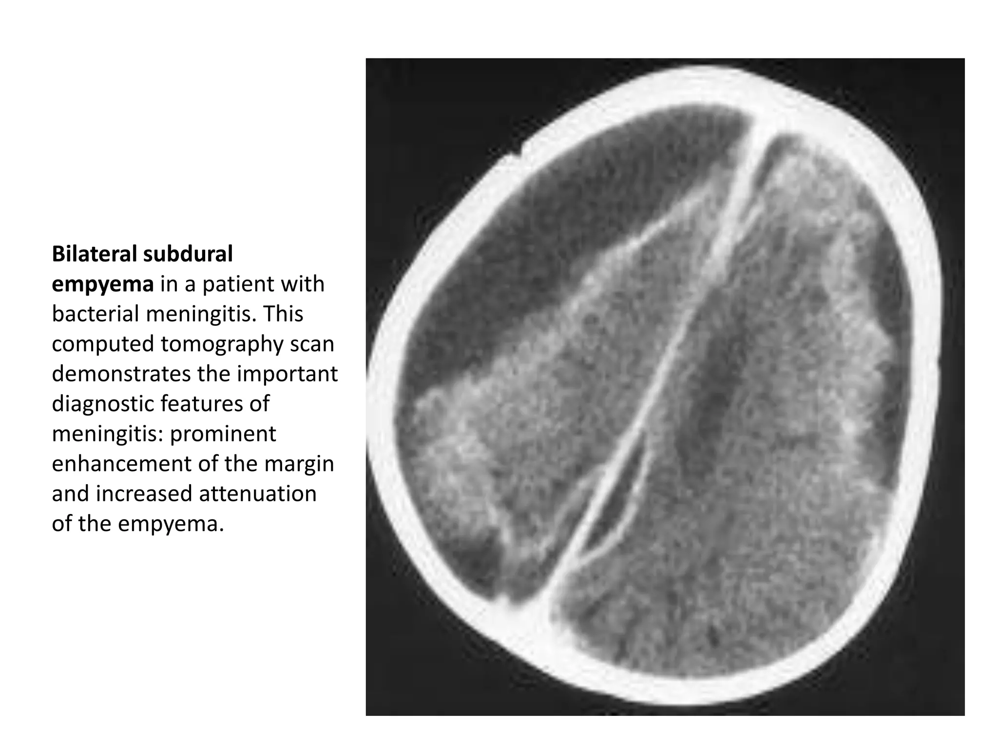 Intracranial infections | PPT