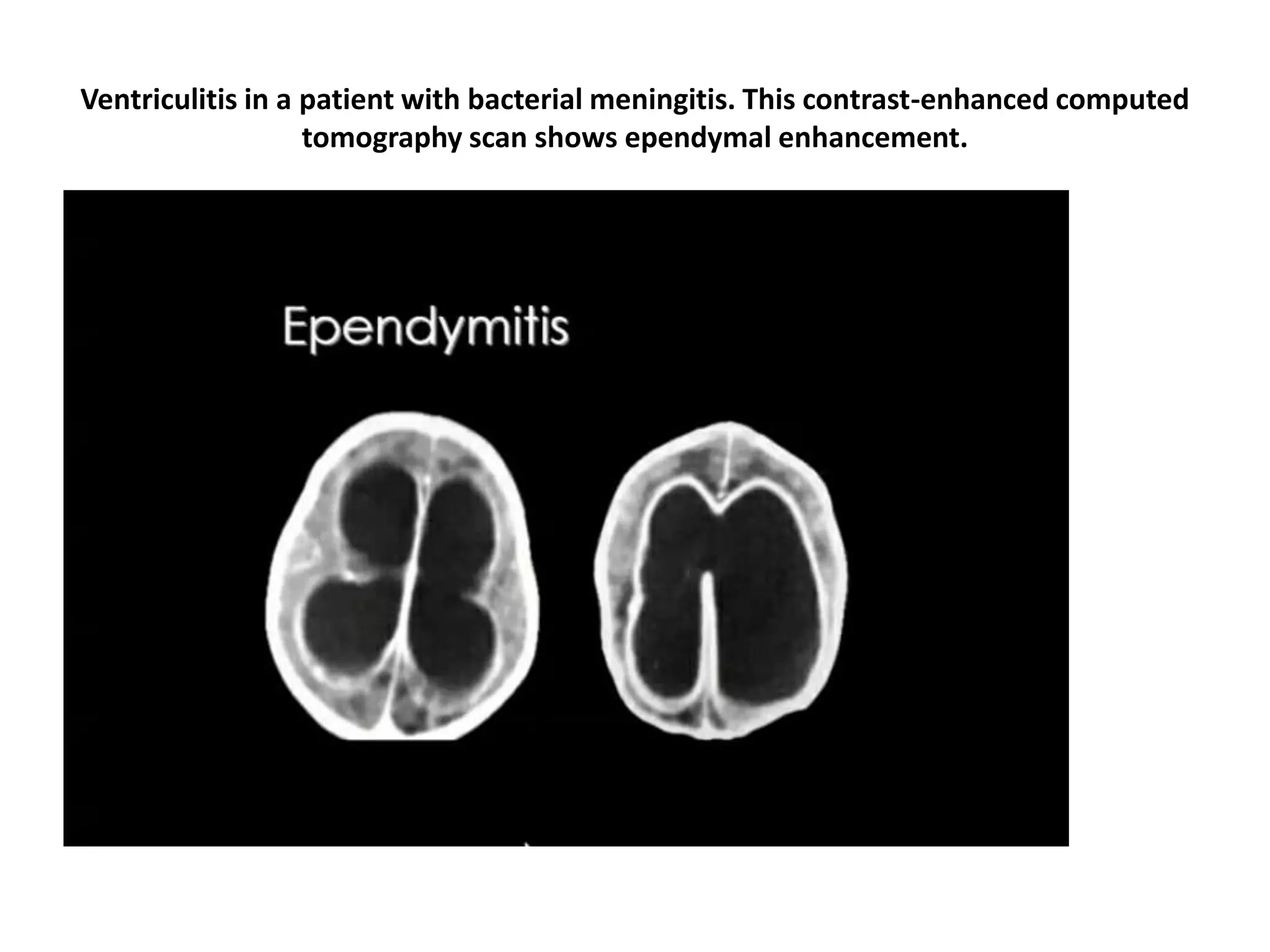 Intracranial infections | PPT