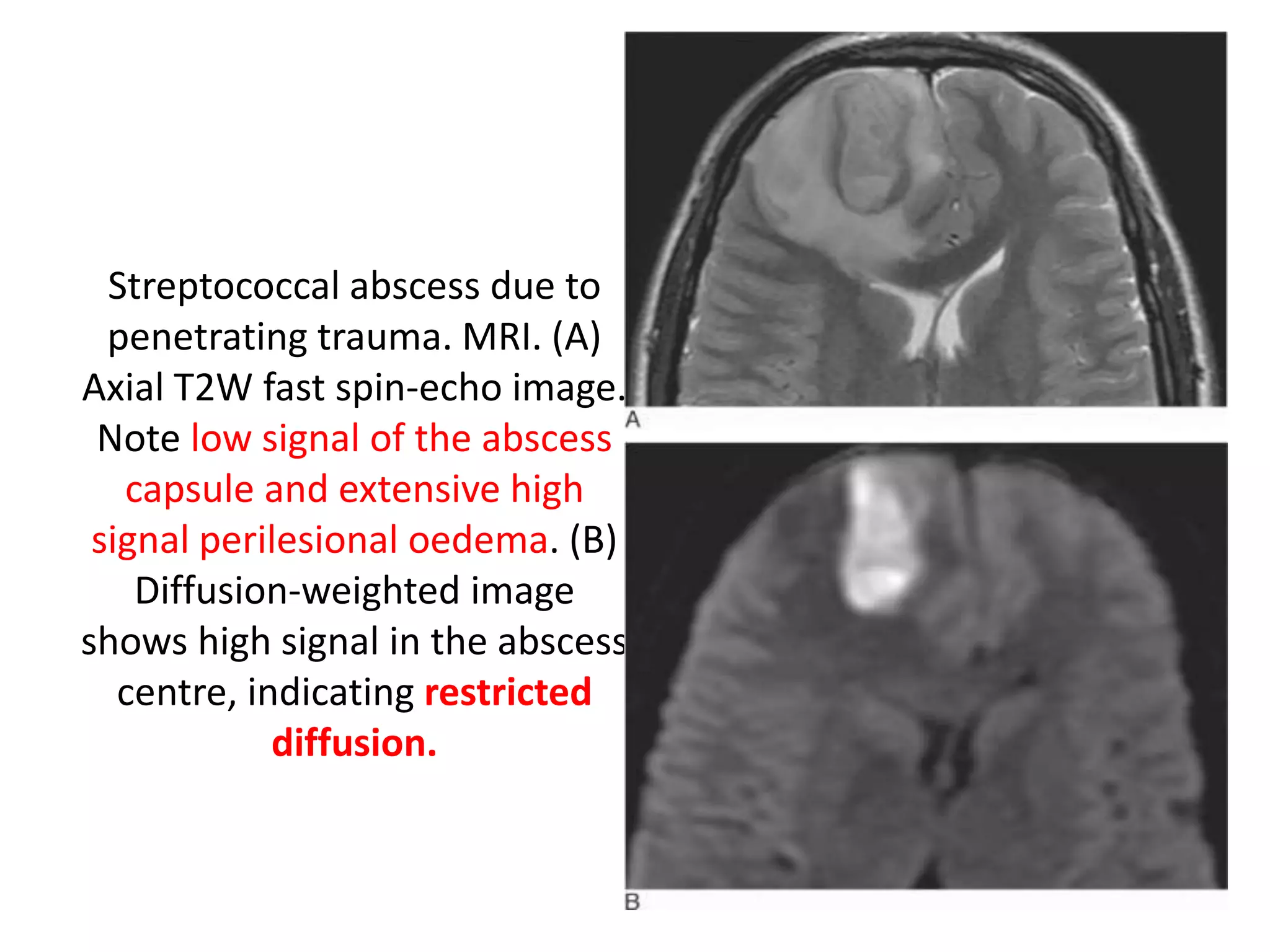 Intracranial infections | PPT