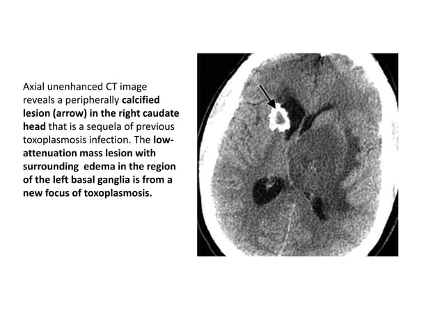Intracranial infections | PPT