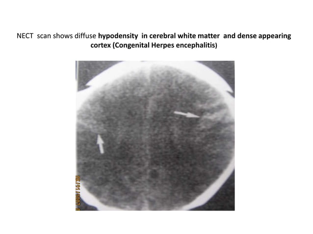 Intracranial infections | PPT