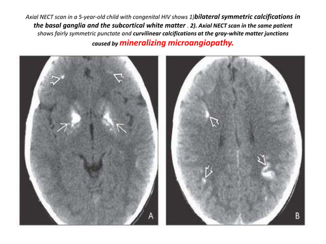 Intracranial infections | PPT