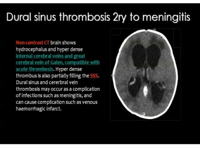 Intracranial infections | PPT
