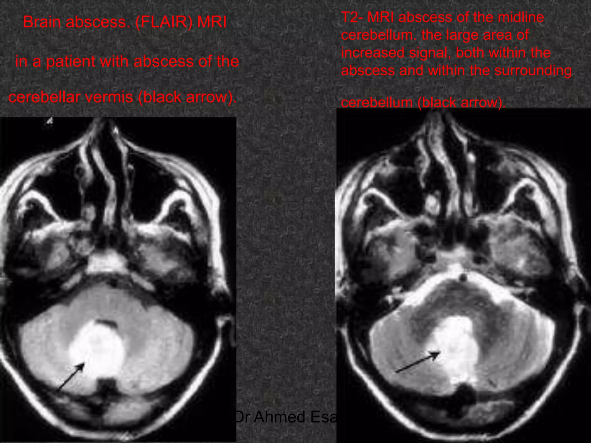 Intracranial inflammatory cystic lesion Dr Ahmed Esawy CT MRI part 3 | PPT