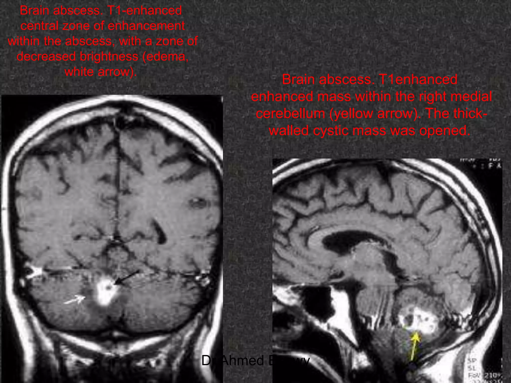 Intracranial inflammatory cystic lesion Dr Ahmed Esawy CT MRI part 3 | PPT