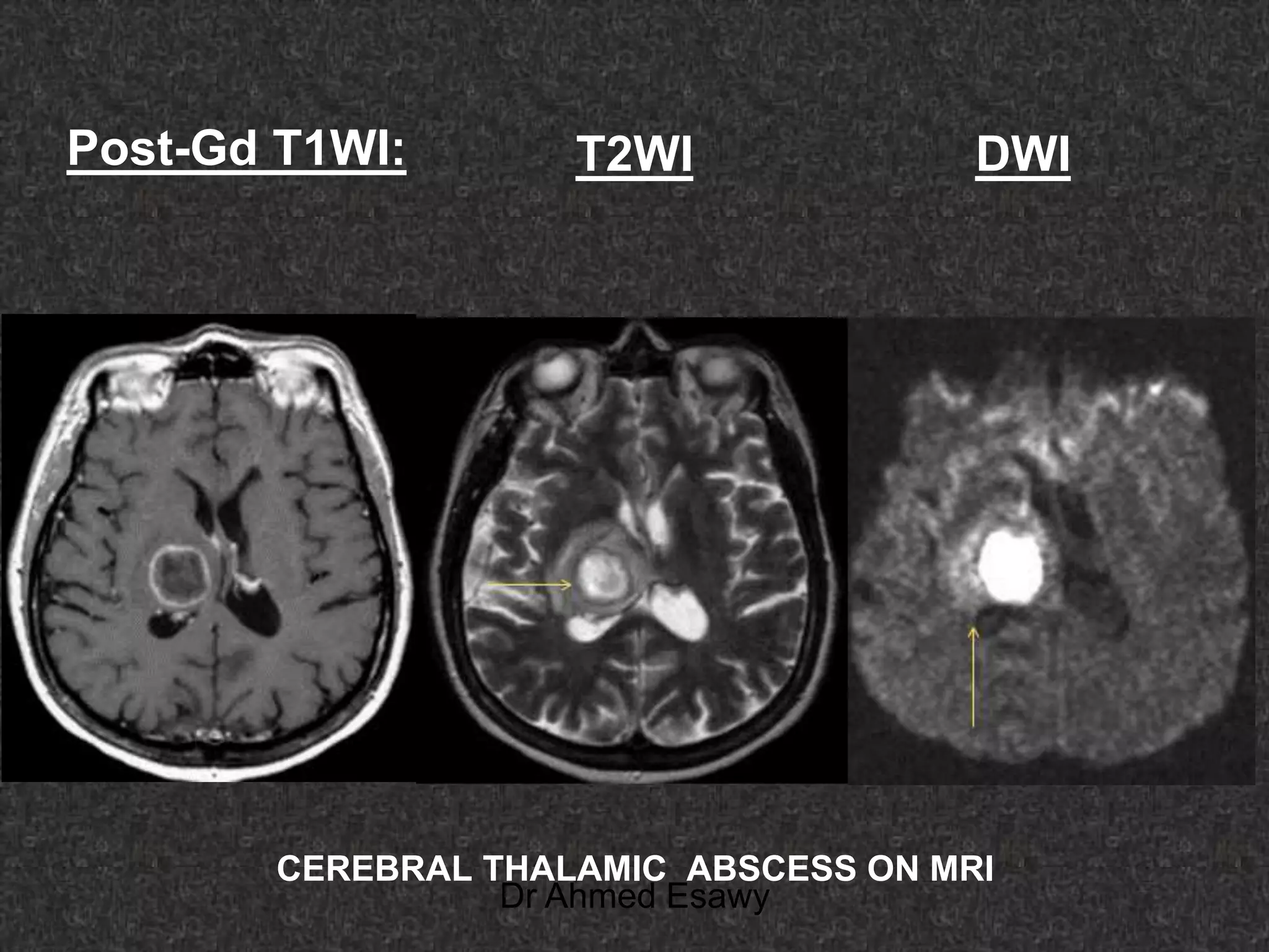 Intracranial inflammatory cystic lesion Dr Ahmed Esawy CT MRI part 3 | PPT