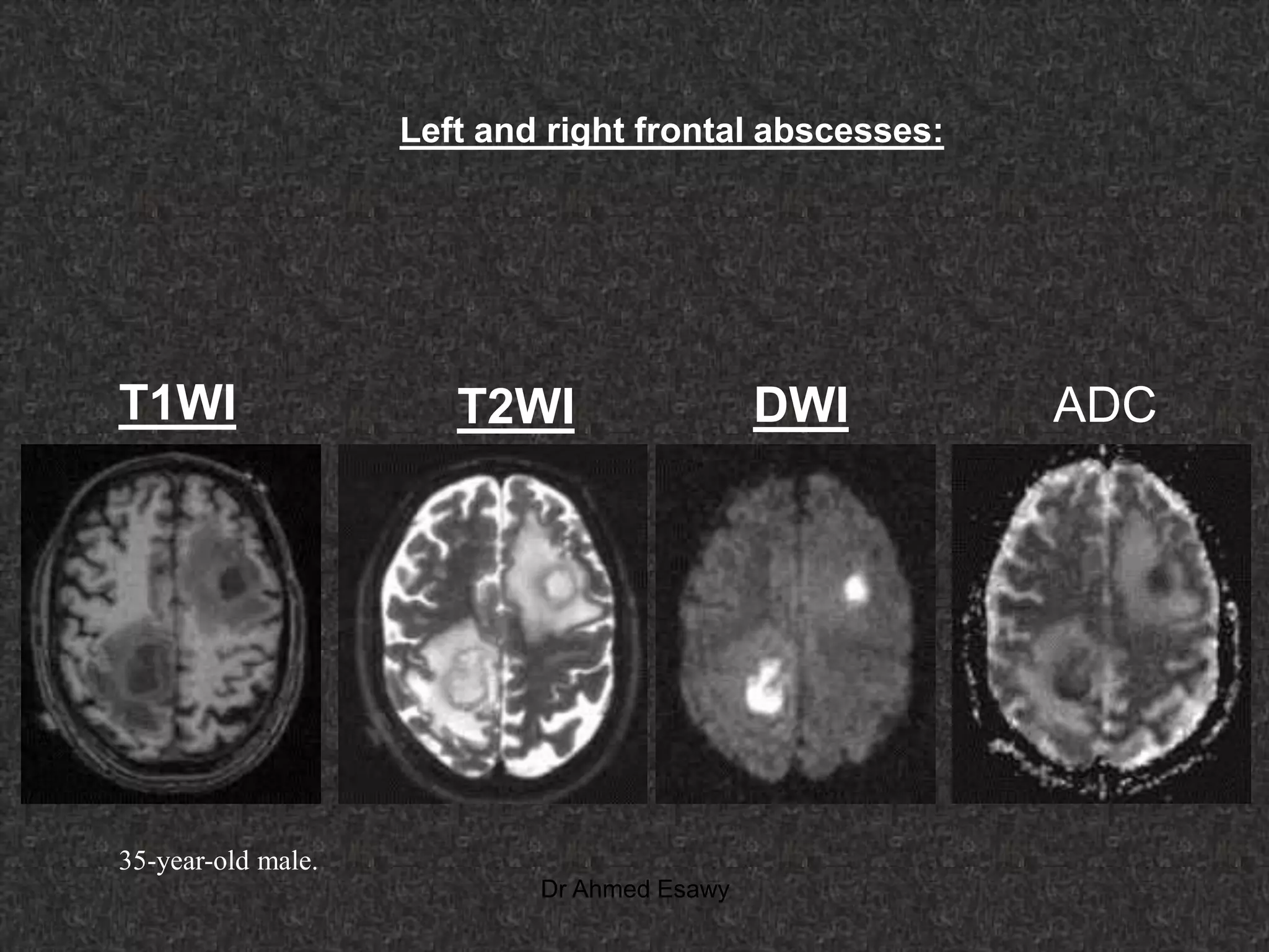 Intracranial inflammatory cystic lesion Dr Ahmed Esawy CT MRI part 3 | PPT