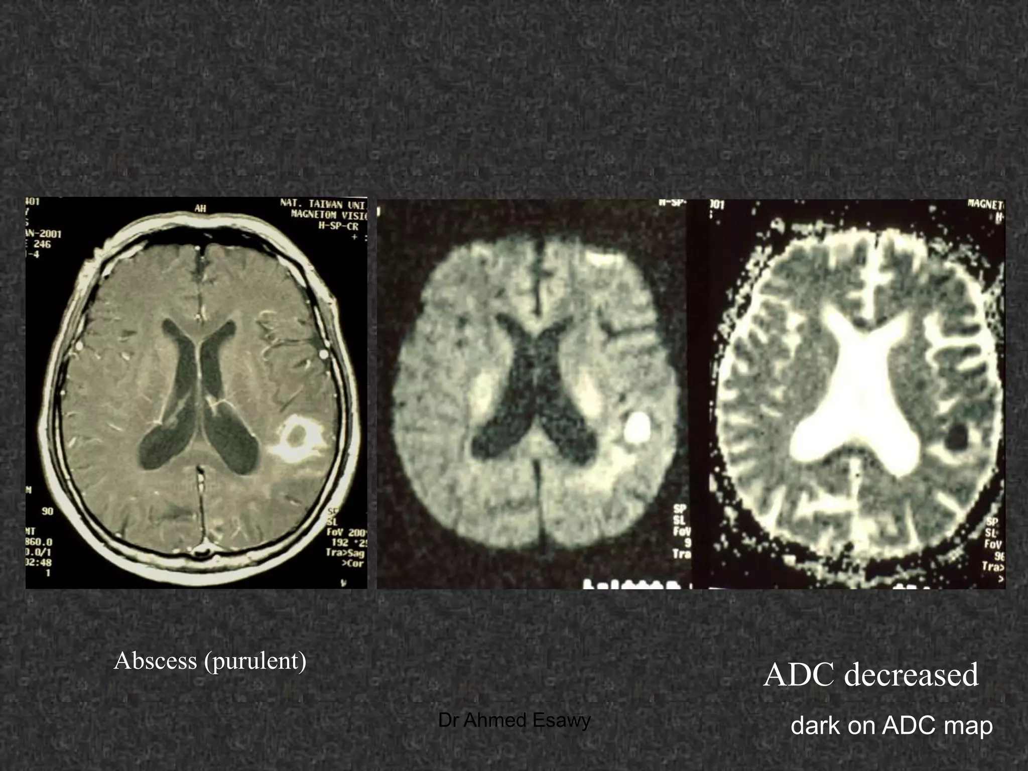 Intracranial inflammatory cystic lesion Dr Ahmed Esawy CT MRI part 3 | PPT
