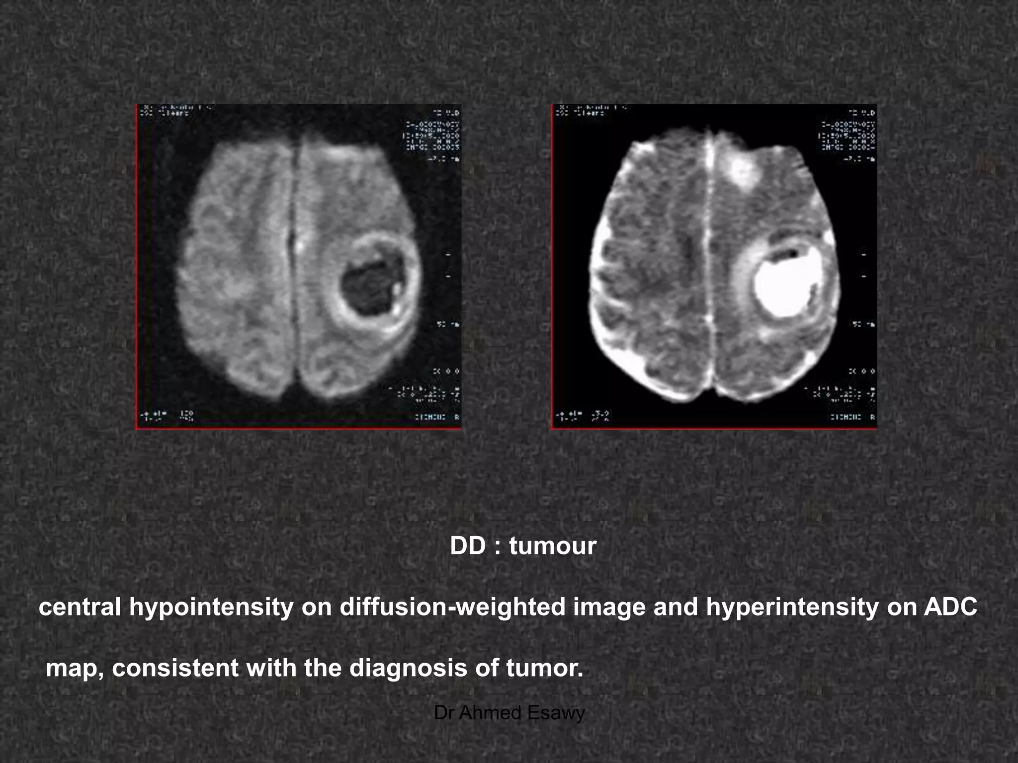 Intracranial inflammatory cystic lesion Dr Ahmed Esawy CT MRI part 3 | PPT