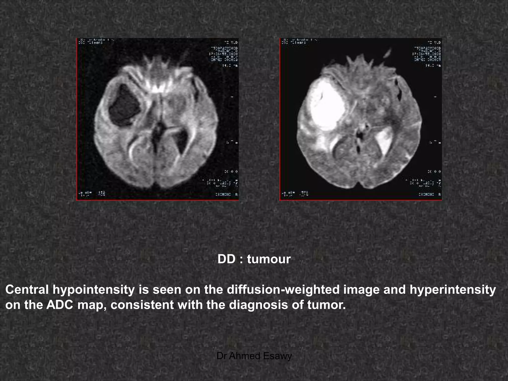 Intracranial inflammatory cystic lesion Dr Ahmed Esawy CT MRI part 3 | PPT