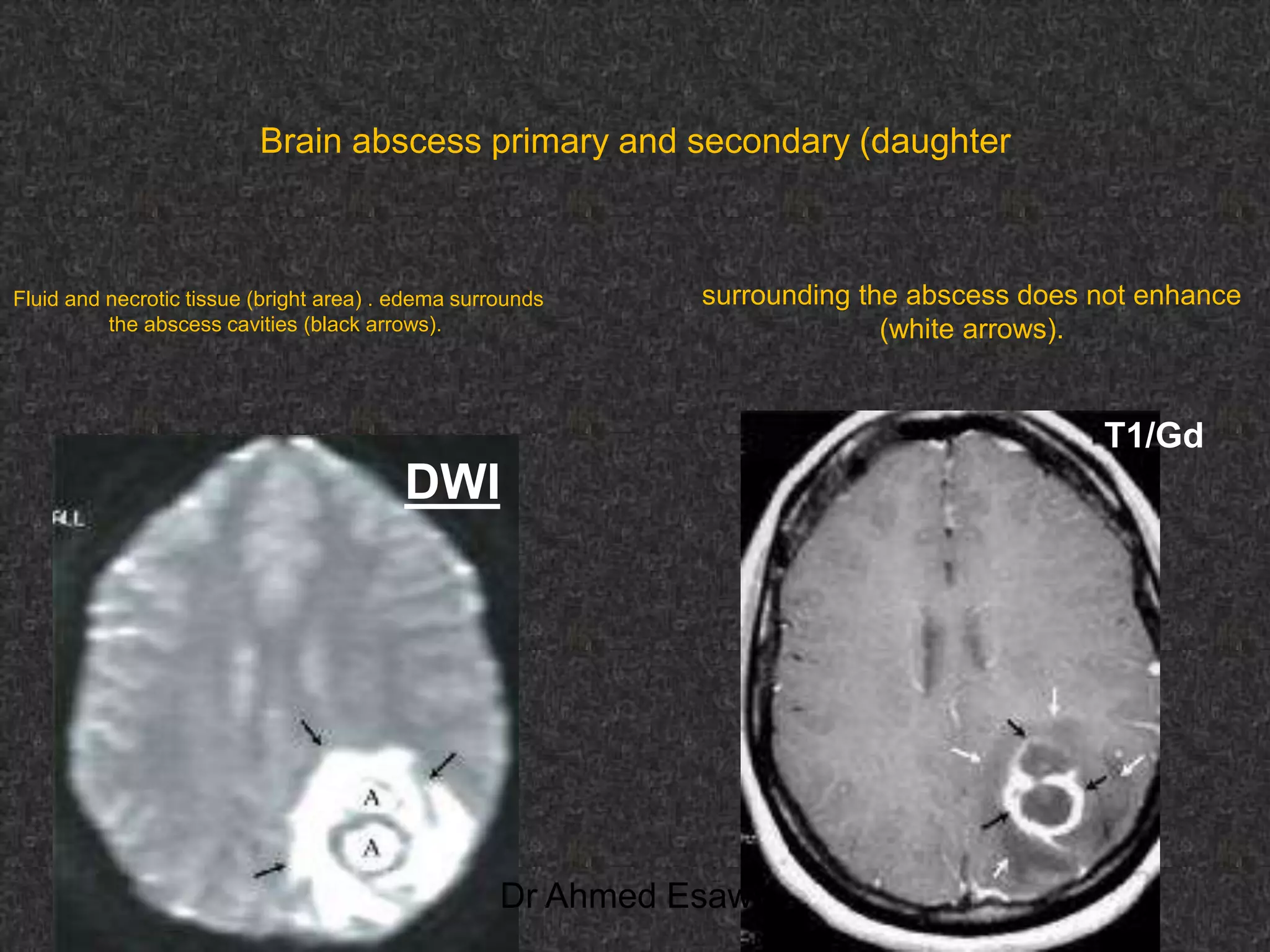 Intracranial inflammatory cystic lesion Dr Ahmed Esawy CT MRI part 3 | PPT