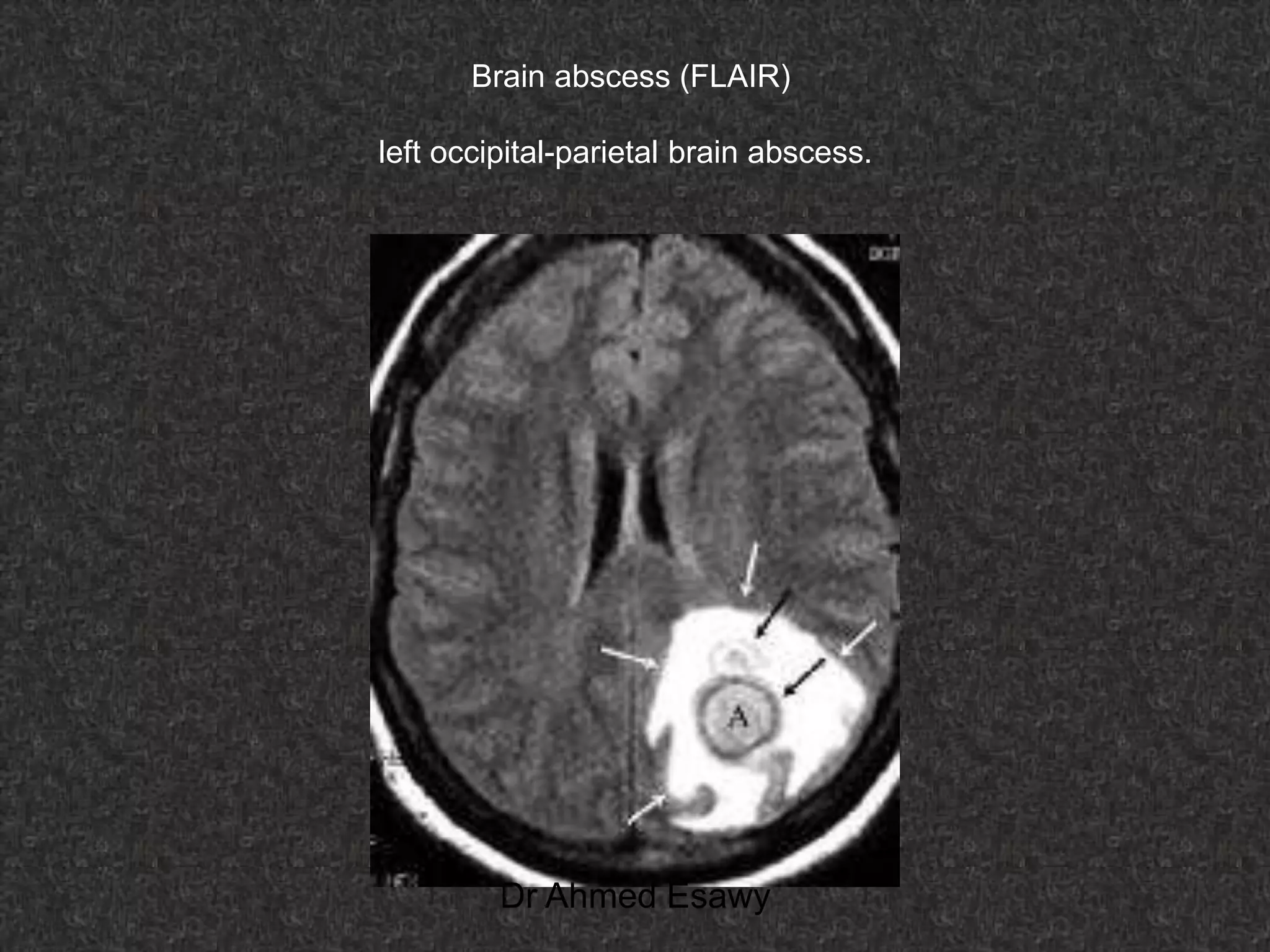 Intracranial inflammatory cystic lesion Dr Ahmed Esawy CT MRI part 3 | PPT