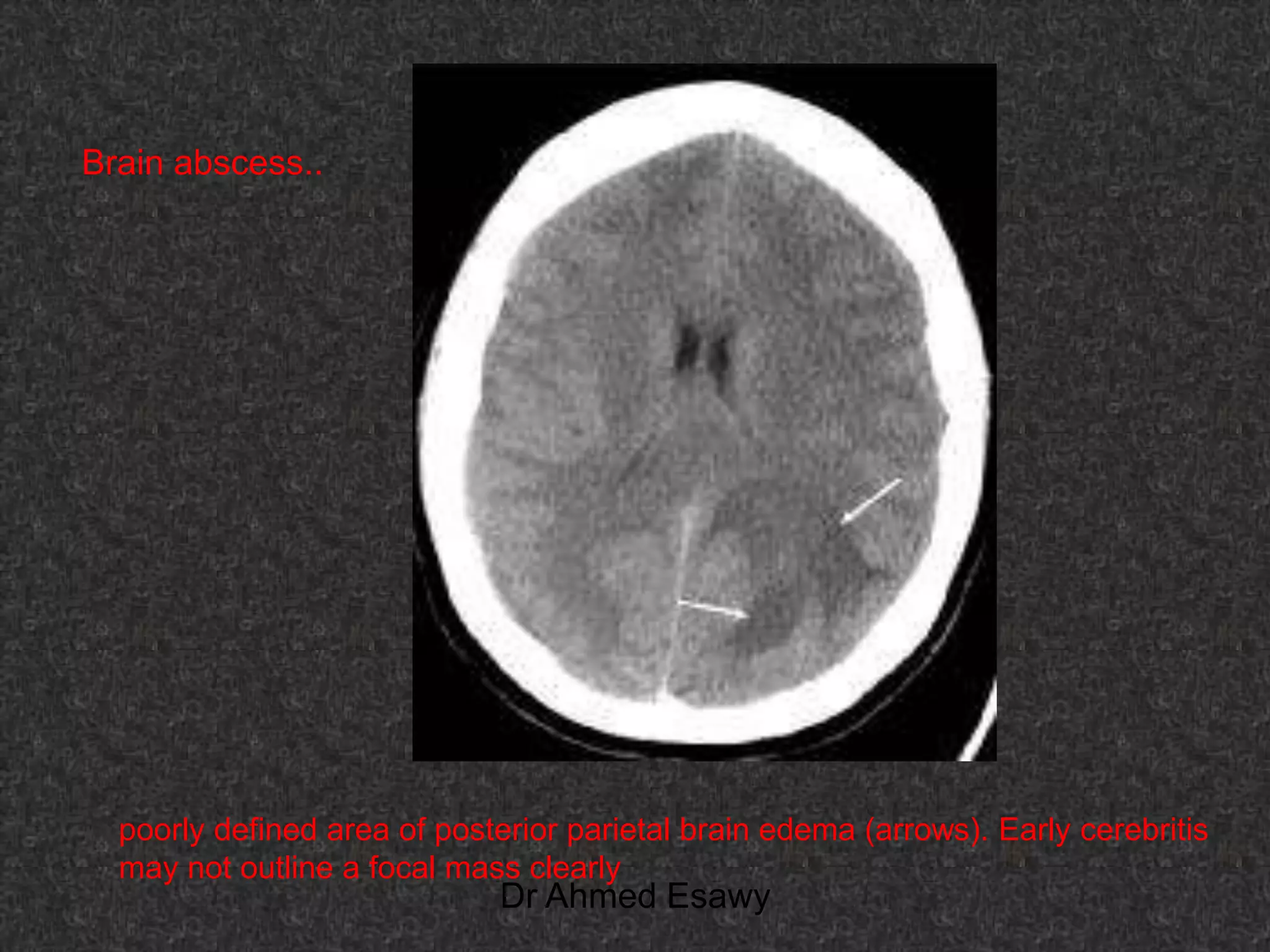 Intracranial inflammatory cystic lesion Dr Ahmed Esawy CT MRI part 3 | PPT