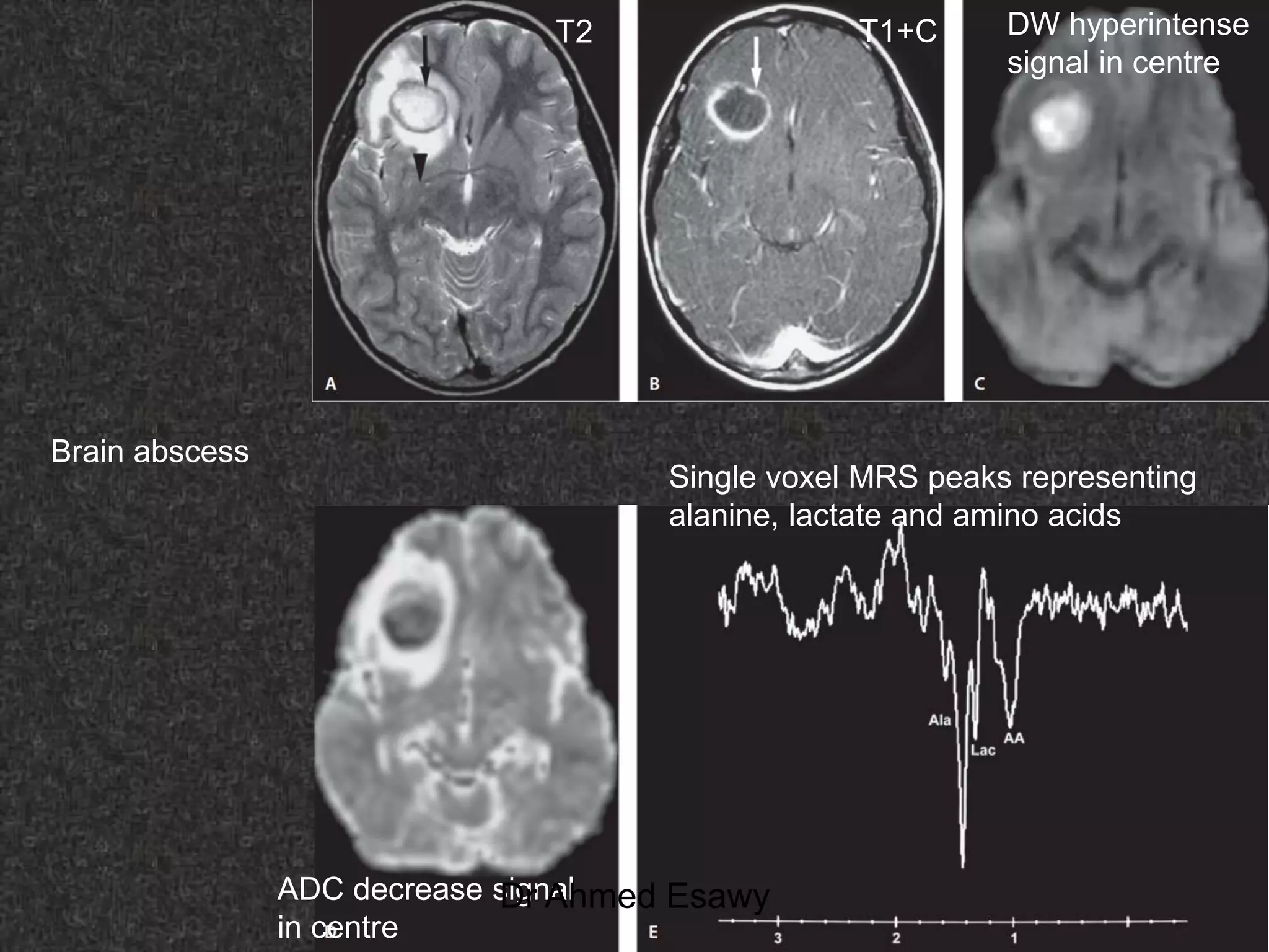 Intracranial inflammatory cystic lesion Dr Ahmed Esawy CT MRI part 3 | PPT