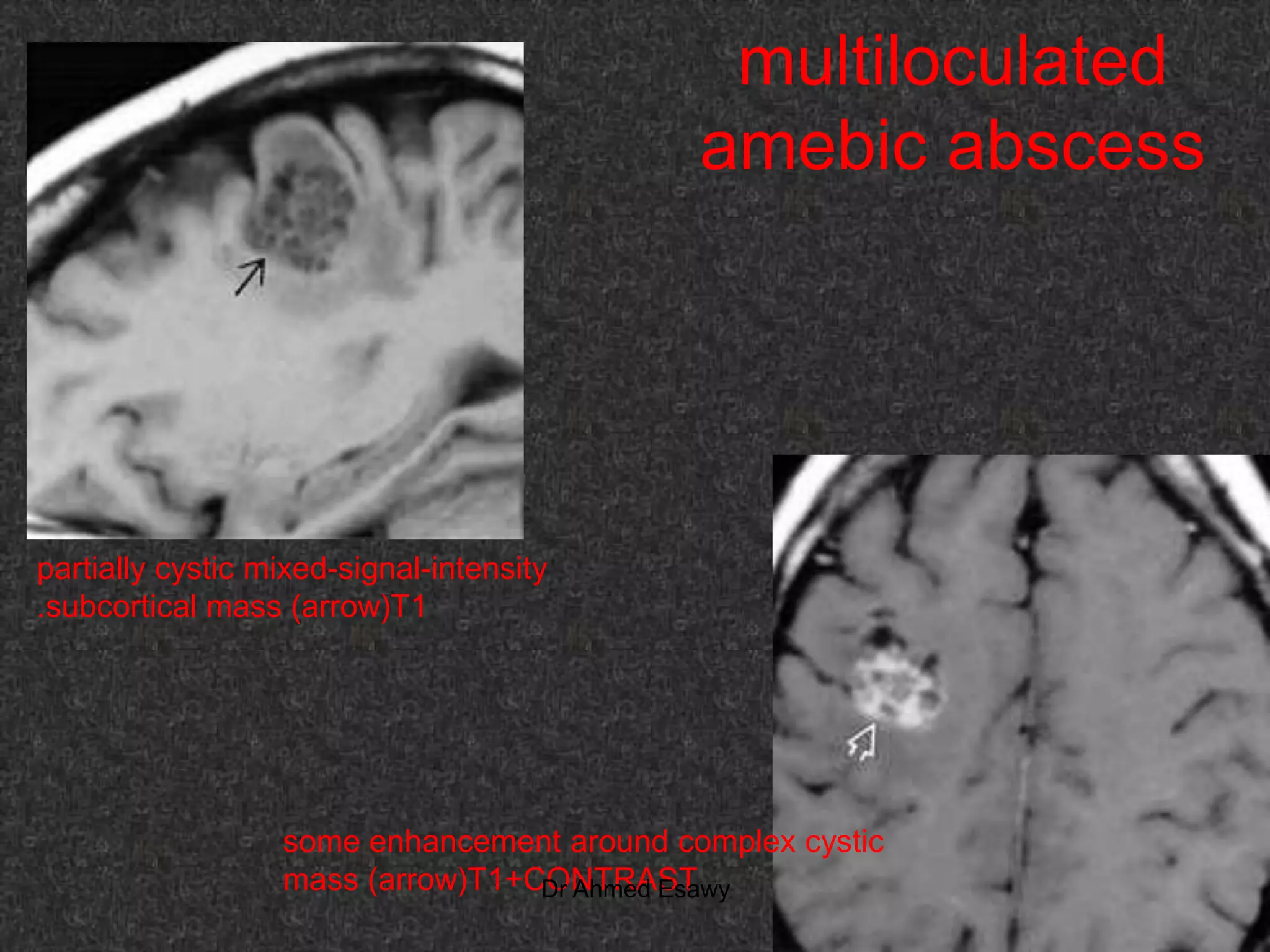 Intracranial inflammatory cystic lesion Dr Ahmed Esawy CT MRI part 3 | PPT