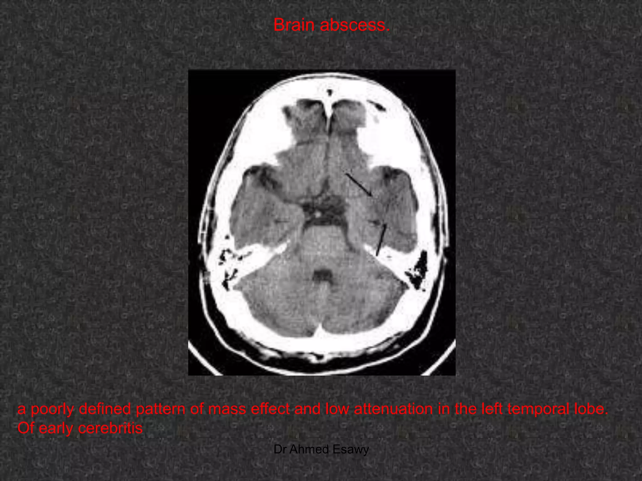 Intracranial inflammatory cystic lesion Dr Ahmed Esawy CT MRI part 3 | PPT