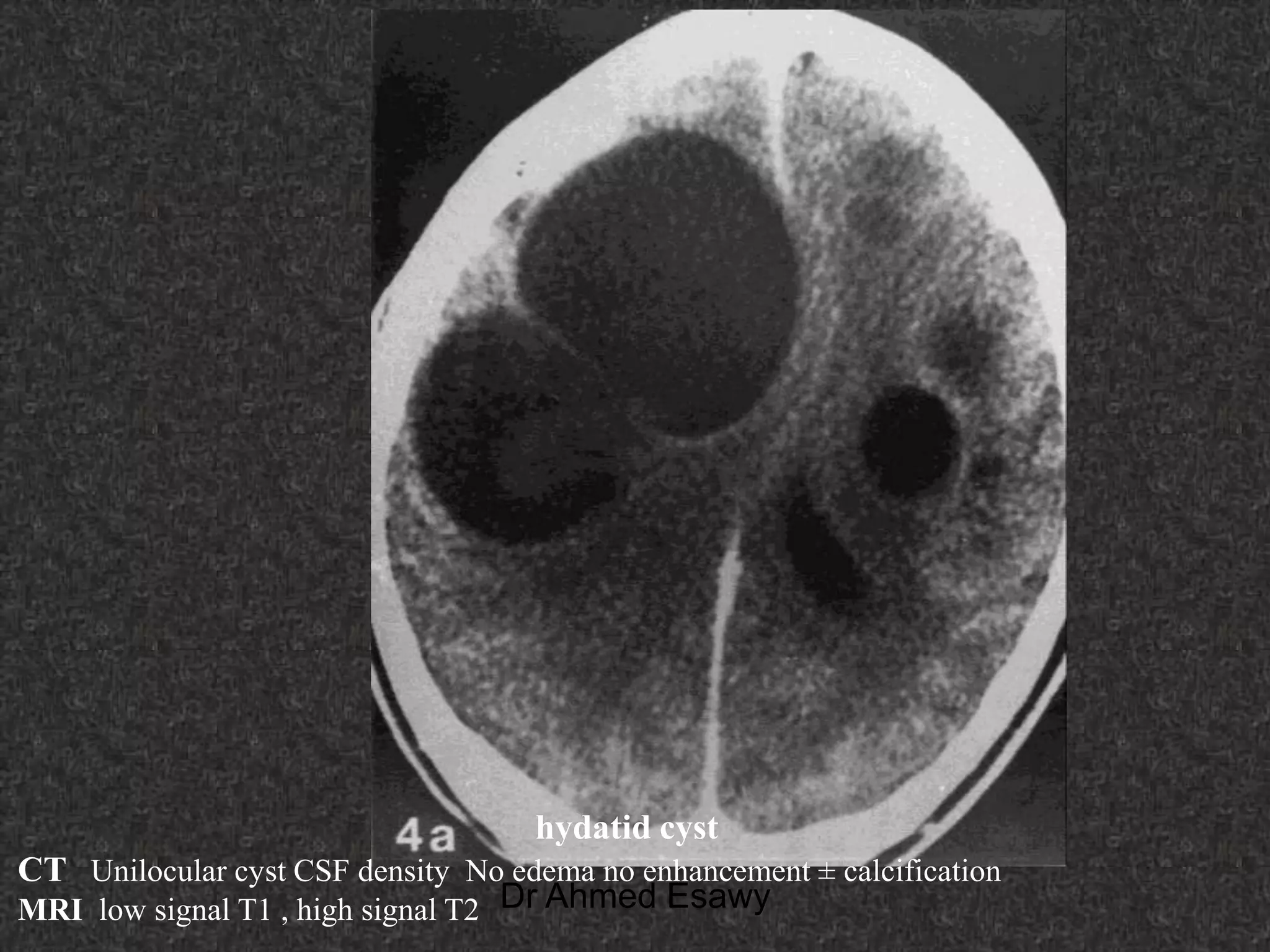 Intracranial inflammatory cystic lesion Dr Ahmed Esawy CT MRI part 3 | PPT