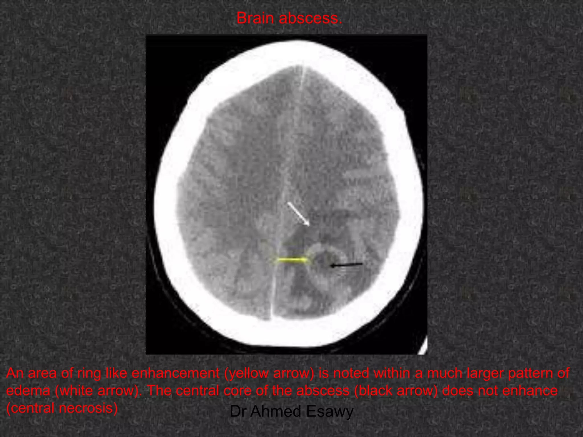 Intracranial inflammatory cystic lesion Dr Ahmed Esawy CT MRI part 3 | PPT