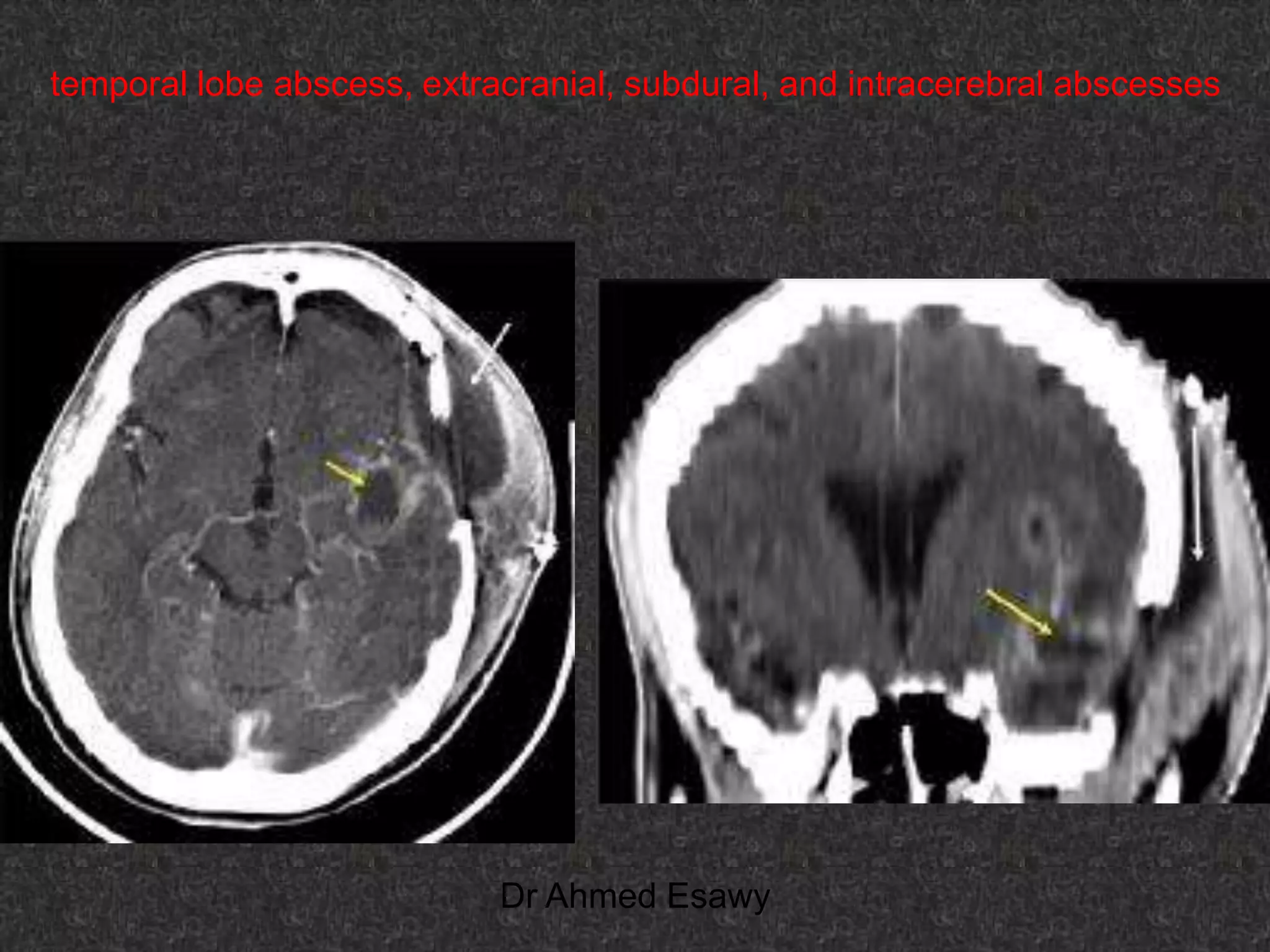 Intracranial inflammatory cystic lesion Dr Ahmed Esawy CT MRI part 3 | PPT