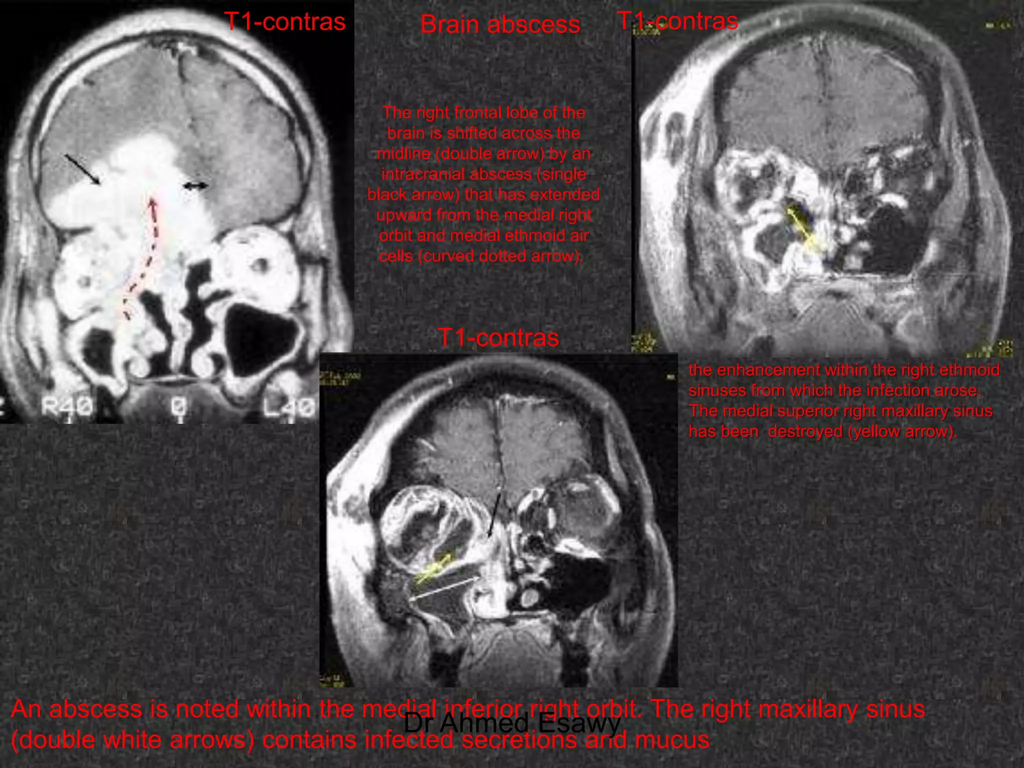 Intracranial inflammatory cystic lesion Dr Ahmed Esawy CT MRI part 3 | PPT