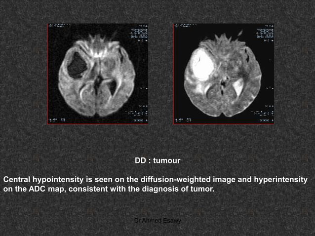 Intracranial inflammatory cystic lesion Dr Ahmed Esawy CT MRI part 3 | PPT