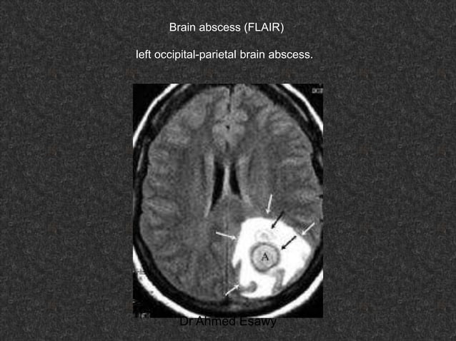 Intracranial inflammatory cystic lesion Dr Ahmed Esawy CT MRI part 3 | PPT