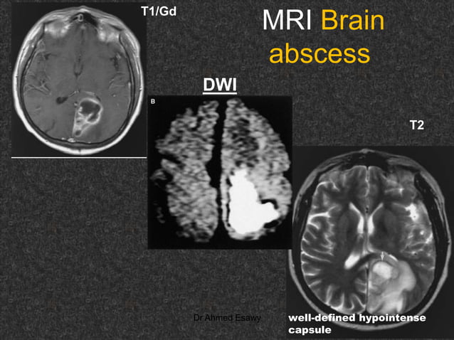 Intracranial inflammatory cystic lesion Dr Ahmed Esawy CT MRI part 3 | PPT