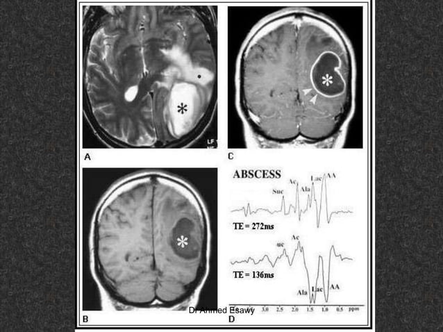 Intracranial inflammatory cystic lesion Dr Ahmed Esawy CT MRI part 3 | PPT