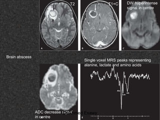 Intracranial inflammatory cystic lesion Dr Ahmed Esawy CT MRI part 3 | PDF