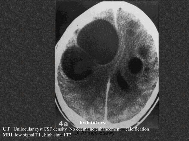 Intracranial inflammatory cystic lesion Dr Ahmed Esawy CT MRI part 3 | PPT