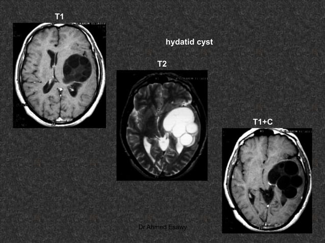 Intracranial inflammatory cystic lesion Dr Ahmed Esawy CT MRI part 3 | PPT