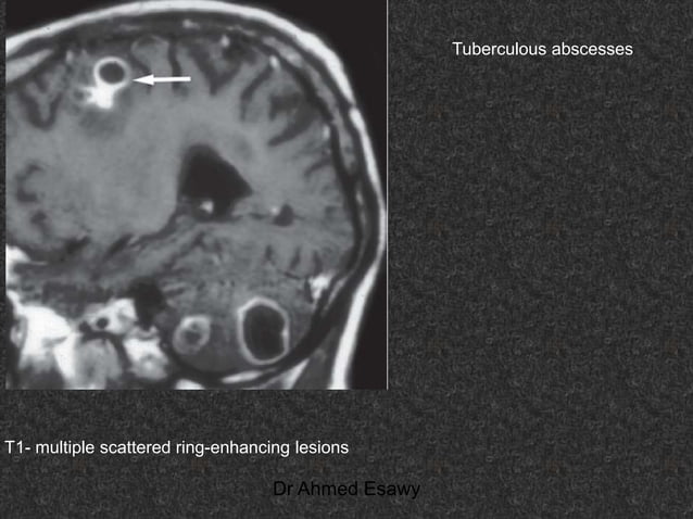 Intracranial inflammatory cystic lesion Dr Ahmed Esawy CT MRI part 3 | PPT