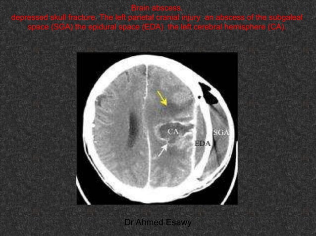 Intracranial inflammatory cystic lesion Dr Ahmed Esawy CT MRI part 3 | PPT