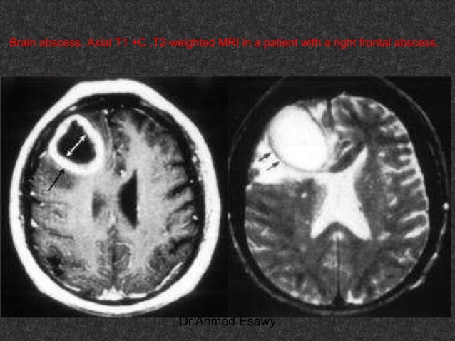 Intracranial inflammatory cystic lesion Dr Ahmed Esawy CT MRI part 3 | PPT