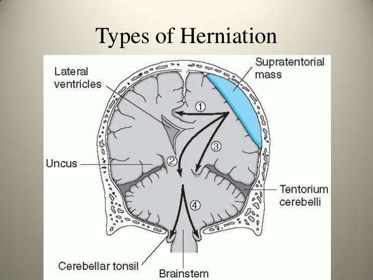 medicine.Intracranial neoplasms.(dr.hawar)