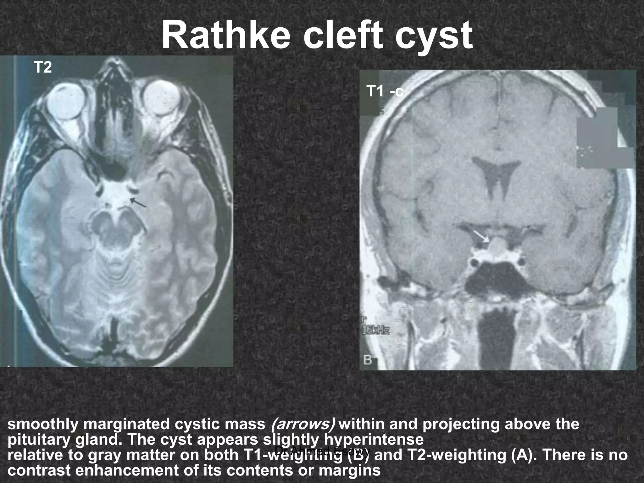 Intracranial non neoplastic cystic lesion Dr Ahmed Esawy CT MRI part 5 ...