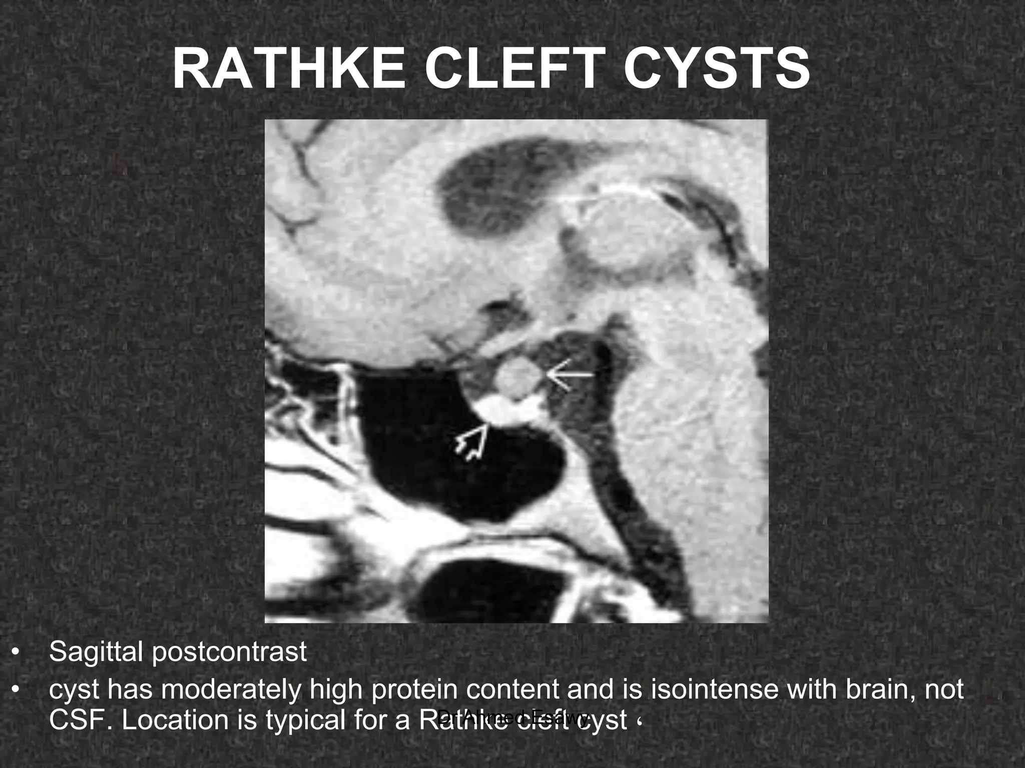 Intracranial non neoplastic cystic lesion Dr Ahmed Esawy CT MRI part 5 ...