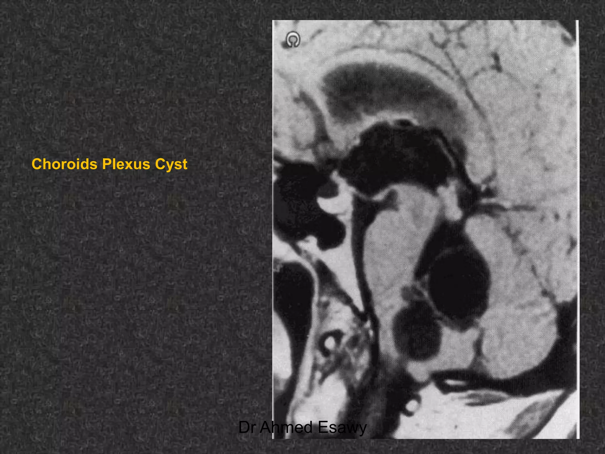 Intracranial non neoplastic cystic lesion Dr Ahmed Esawy CT MRI part 5 ...