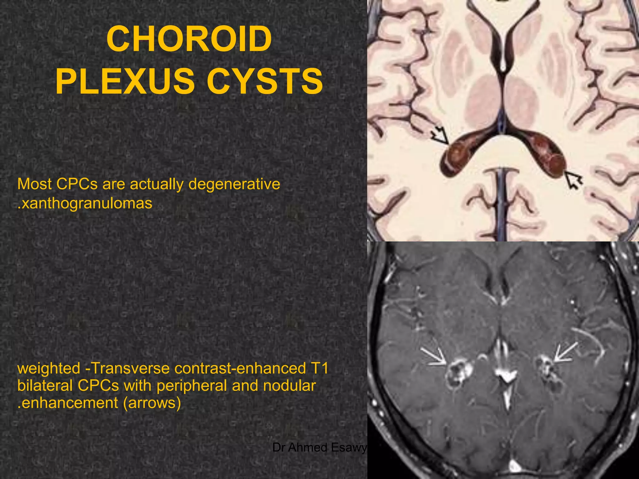 Intracranial non neoplastic cystic lesion Dr Ahmed Esawy CT MRI part 5 ...