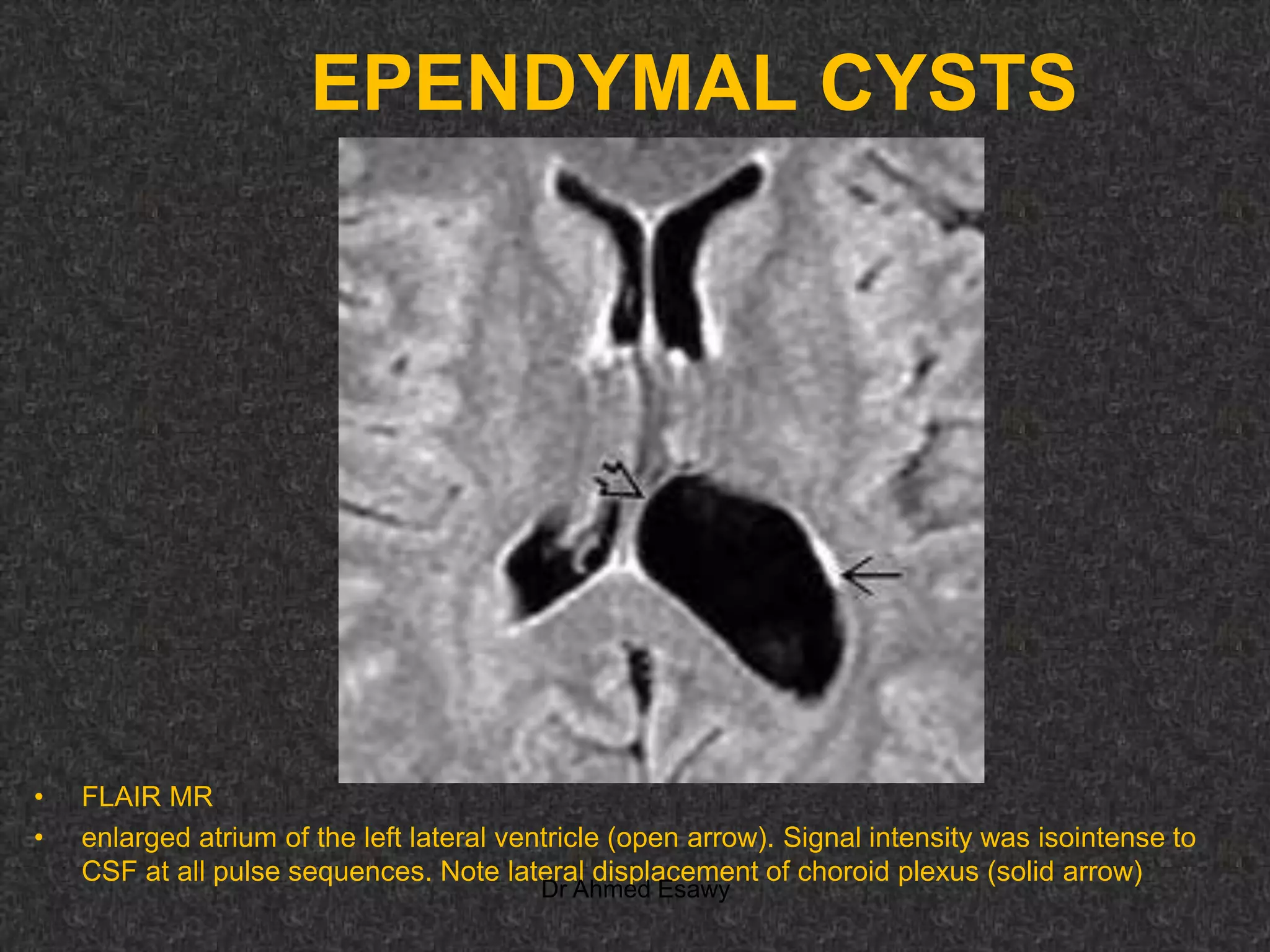 Intracranial non neoplastic cystic lesion Dr Ahmed Esawy CT MRI part 5 ...