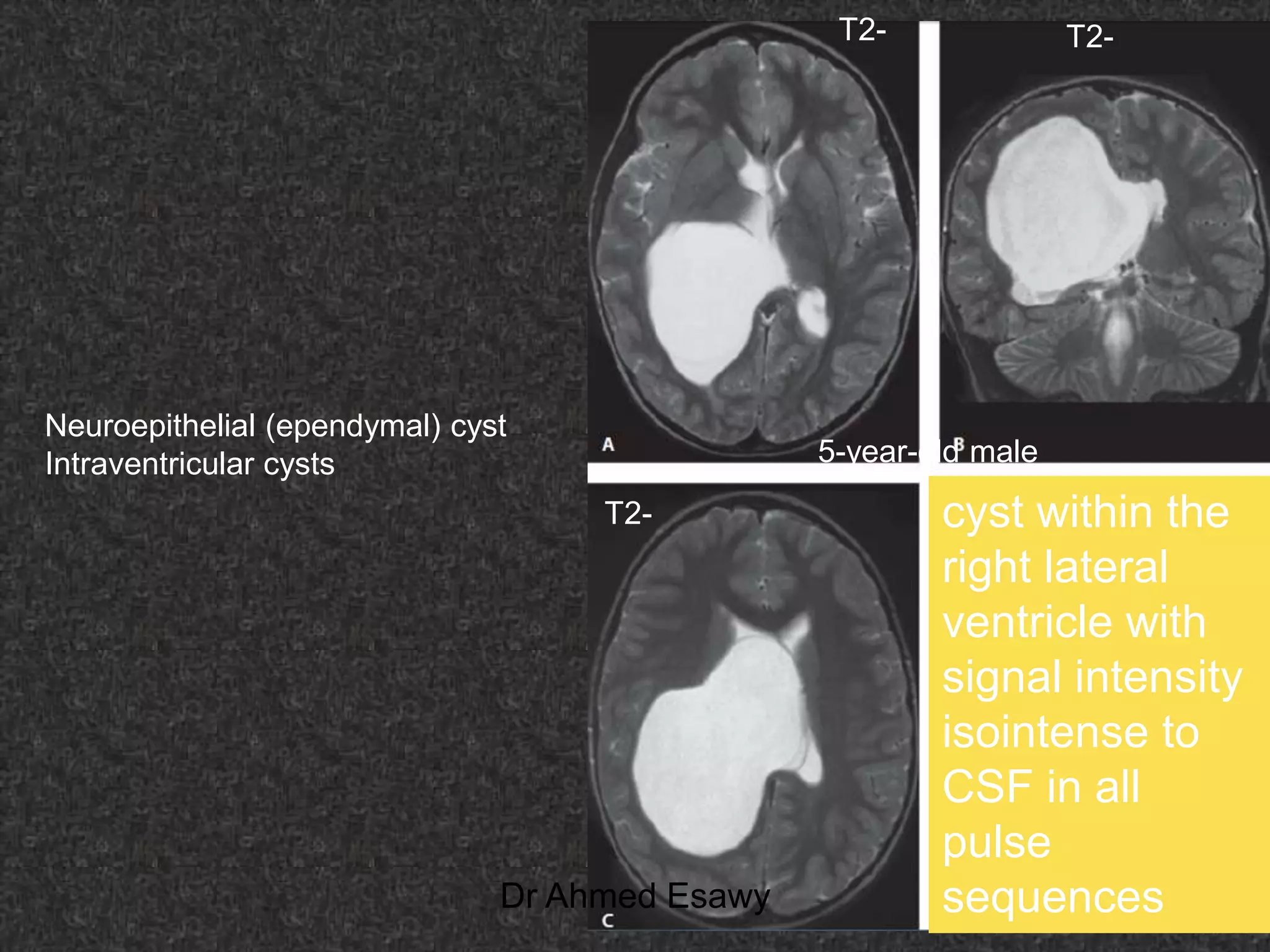 Intracranial non neoplastic cystic lesion Dr Ahmed Esawy CT MRI part 5 ...