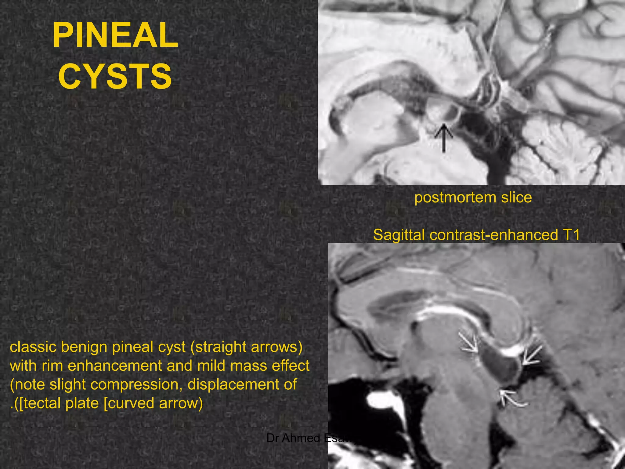 Intracranial non neoplastic cystic lesion Dr Ahmed Esawy CT MRI part 5 ...