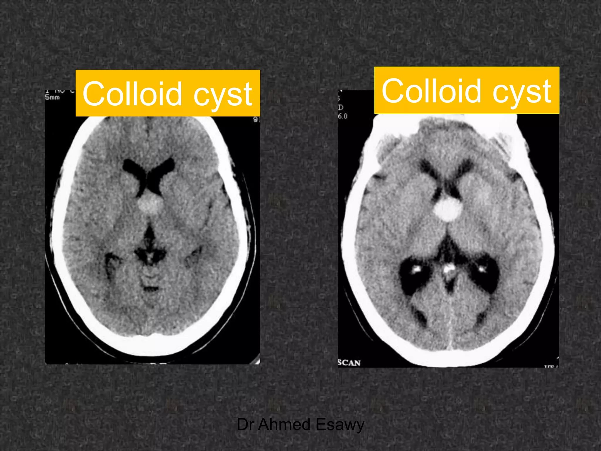 Intracranial non neoplastic cystic lesion Dr Ahmed Esawy CT MRI part 5 ...