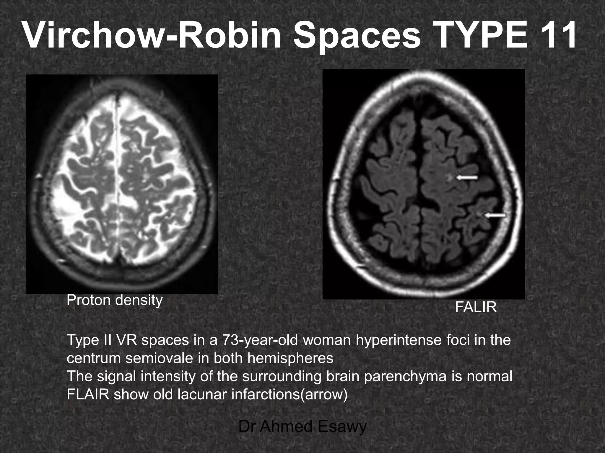 Intracranial non neoplastic cystic lesion Dr Ahmed Esawy CT MRI part 5 ...